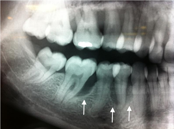 Radiografia De Doenca Periodontal Quando Um Paciente Traz Os Exames